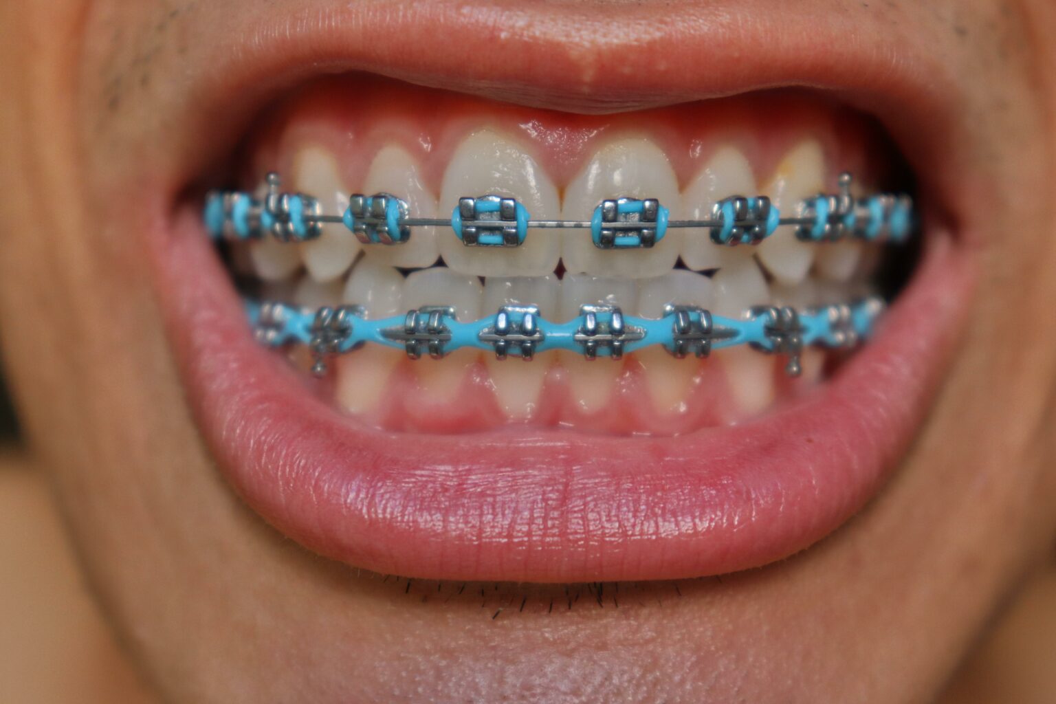 Top Rankings Of Braces Colors (By Season) - Yang Orthodontics