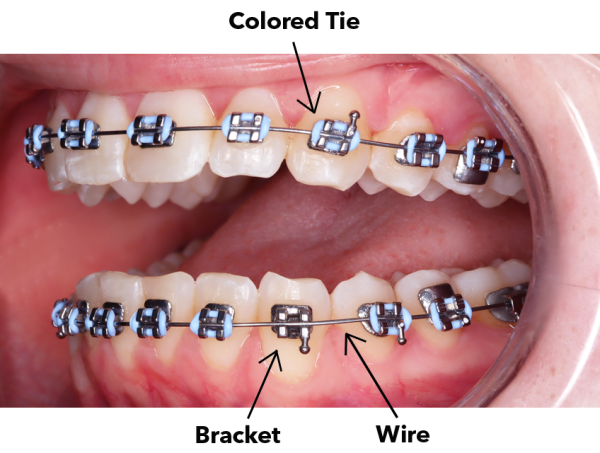 Braces and Invisalign: How They Work - Yang Orthodontics