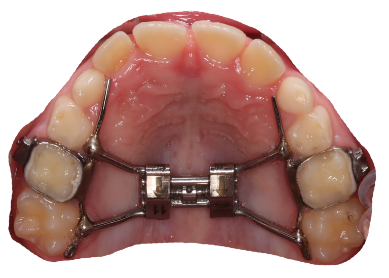 Rapid Palatal Expander (Palate Expander) - Yang Orthodontics