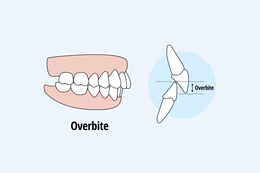 Treatment Options for an Overbite - Yang Orthodontics